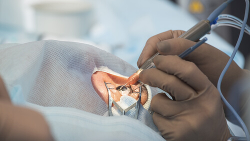 What to expect from laser surgery: Does laser eye surgery hurt?Nelsons ...